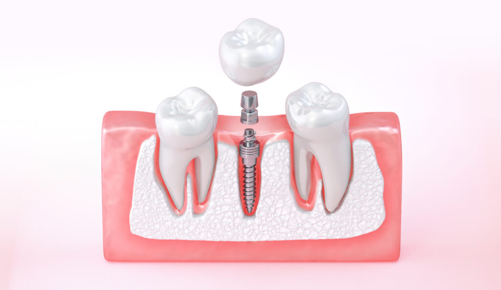 Dental teeth implant. Placement of a titanium implant into the jawbone ...