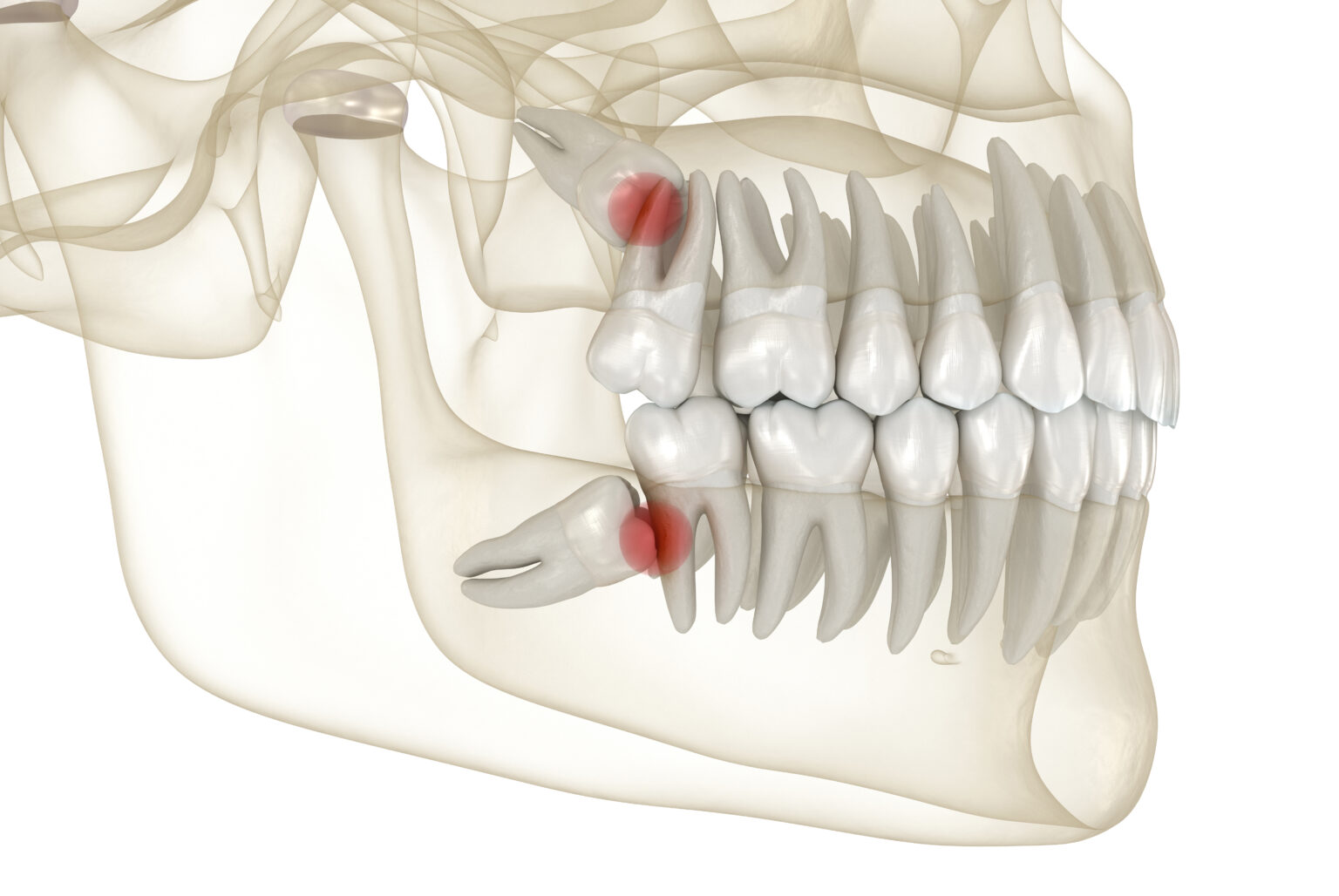 How Extracting Wisdom Teeth Protects Smiles | Cerritos, CA