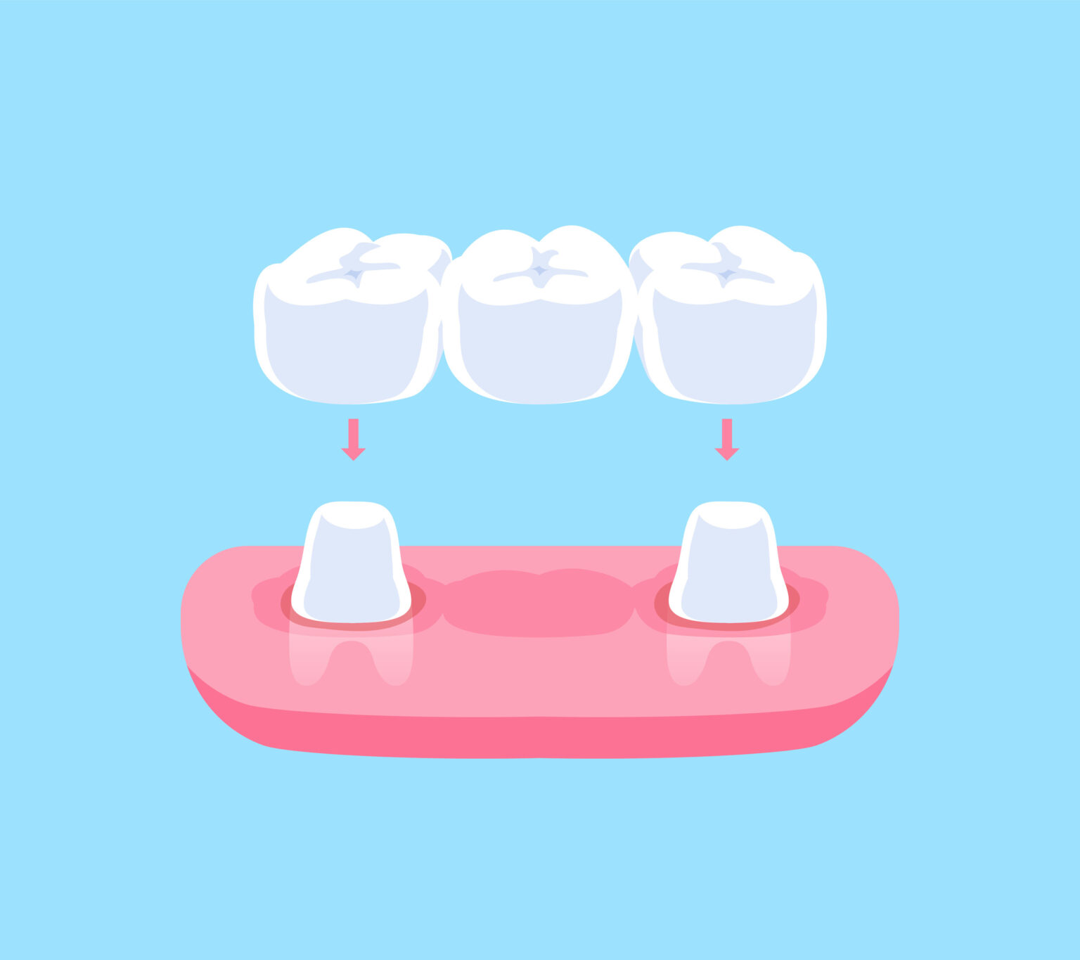 Bridges Mean Replacement Without Surgery | Cerritos, CA