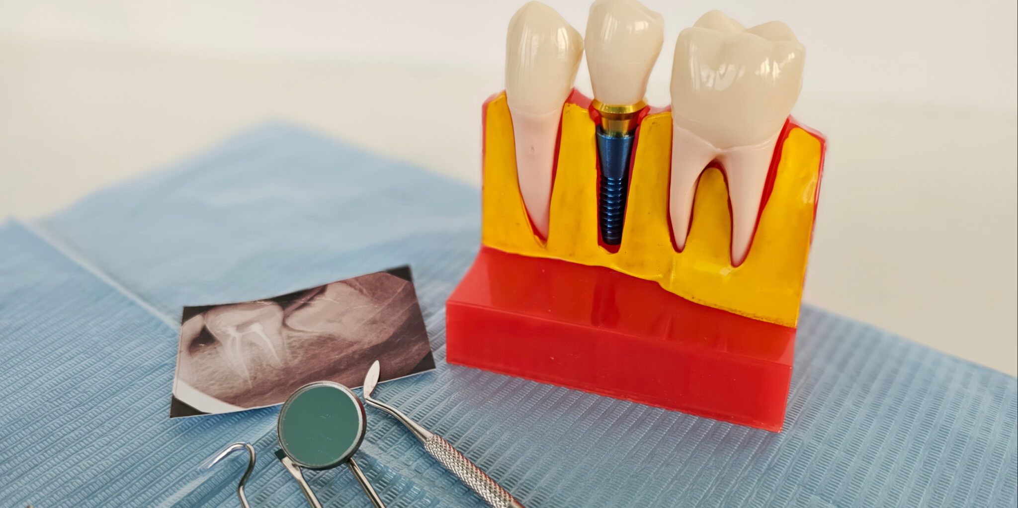 Dental Implants Could Mean A Full Smile Again | Cerritos, CA